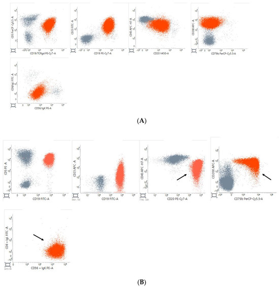 What Does Atypical Chronic Lymphocytic Leukemia Really Mean? A ...