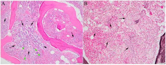 Molecular Genetic Profile of Myelofibrosis: Implications in the ...