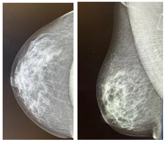 Breast-Conserving Surgery Guided with Magnetic Seeds vs. Wires: A ...