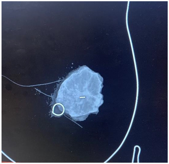 Breast-Conserving Surgery Guided with Magnetic Seeds vs. Wires: A ...