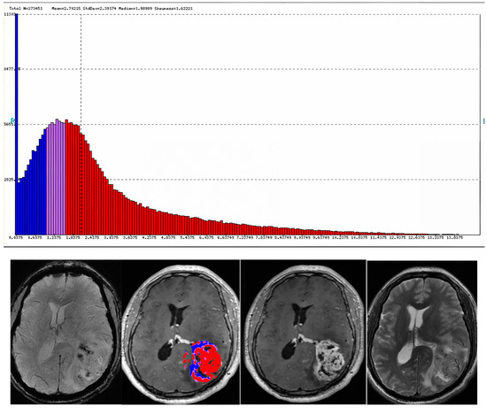 Advances in Neuro-Oncological Imaging: An Update on Diagnostic Approach ...