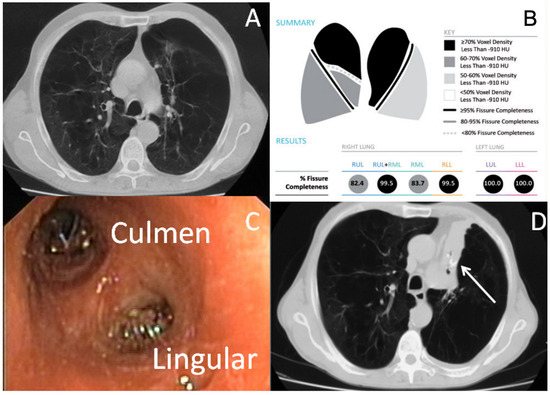 Cancers | Free Full-Text | Lung Resection for Non-Small Cell Lung ...