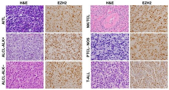 Upregulation of Enhancer of Zeste Homolog 2 (EZH2) with Associated pERK Co-Expression and PRC2 ...