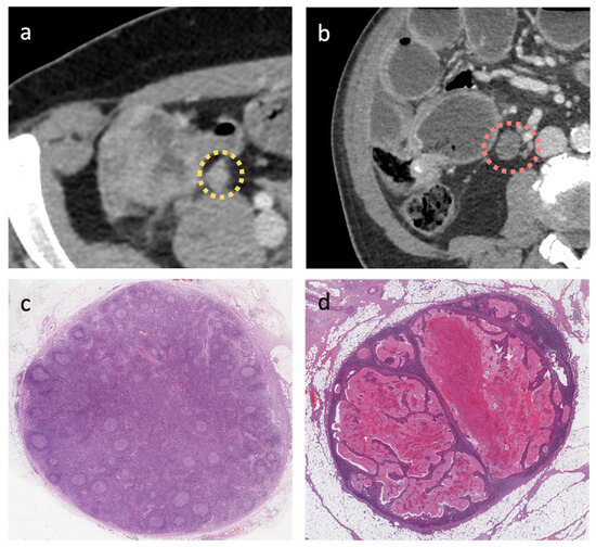 Is CT Radiomics Superior to Morphological Evaluation for pN0 ...