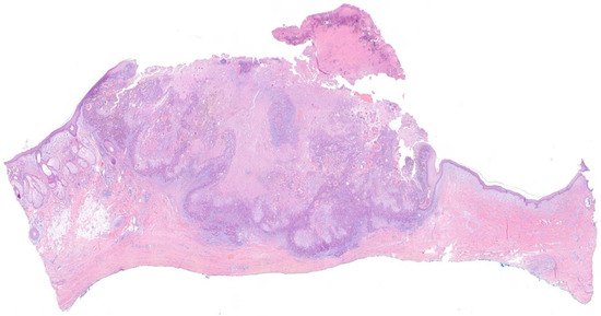 Management of Cutaneous Squamous Cell Carcinoma of the Scalp: The Role ...