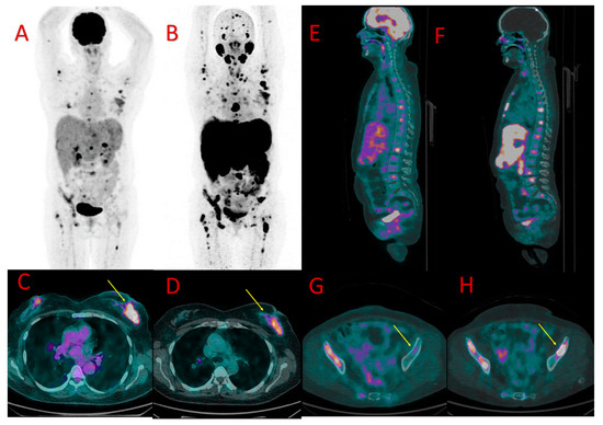 Cancers | Free Full-Text | Head-to-Head Comparison of [18F]PSMA-1007 ...
