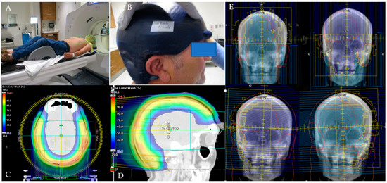 Scalp Irradiation with 3D-Milled Bolus: Initial Dosimetric and Clinical ...