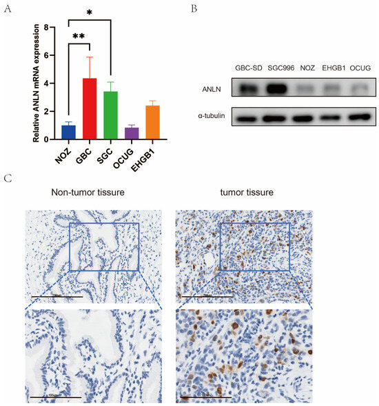 ANLN Promotes the Proliferation and Migration of Gallbladder Cancer ...