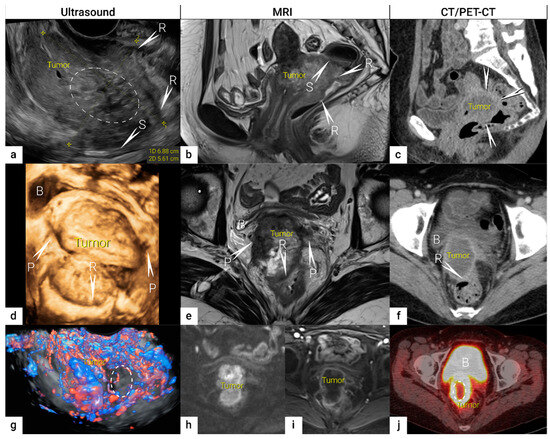 The Role of Imaging in Cervical Cancer Staging: ESGO/ESTRO/ESP ...