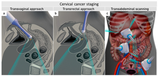 The Role of Imaging in Cervical Cancer Staging: ESGO/ESTRO/ESP ...