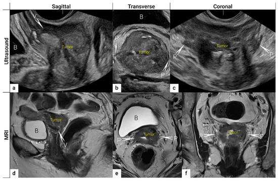 The Role of Imaging in Cervical Cancer Staging: ESGO/ESTRO/ESP ...