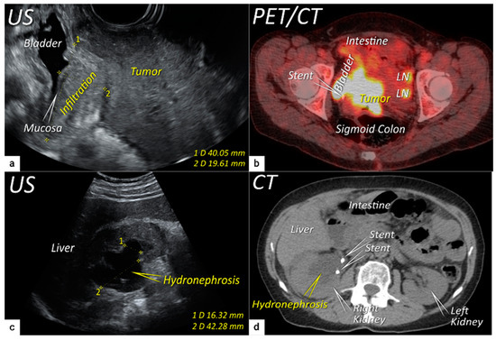 The Role of Imaging in Cervical Cancer Staging: ESGO/ESTRO/ESP ...