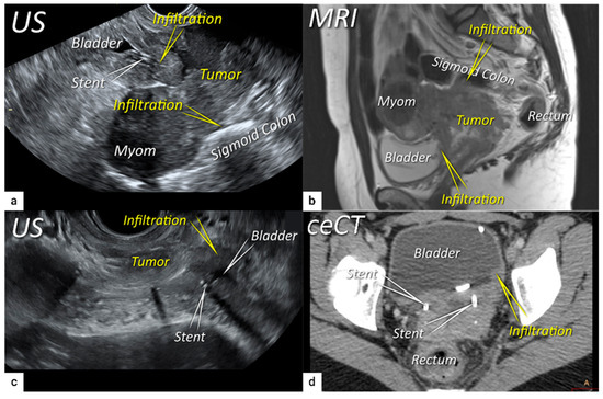 The Role of Imaging in Cervical Cancer Staging: ESGO/ESTRO/ESP ...