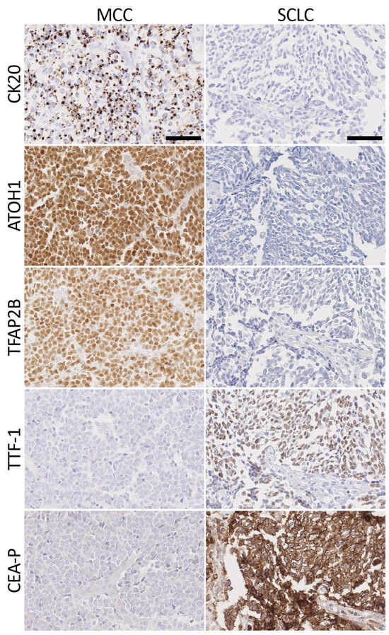 ATOH1, TFAP2B, and CEACAM6 as Immunohistochemical Markers to ...