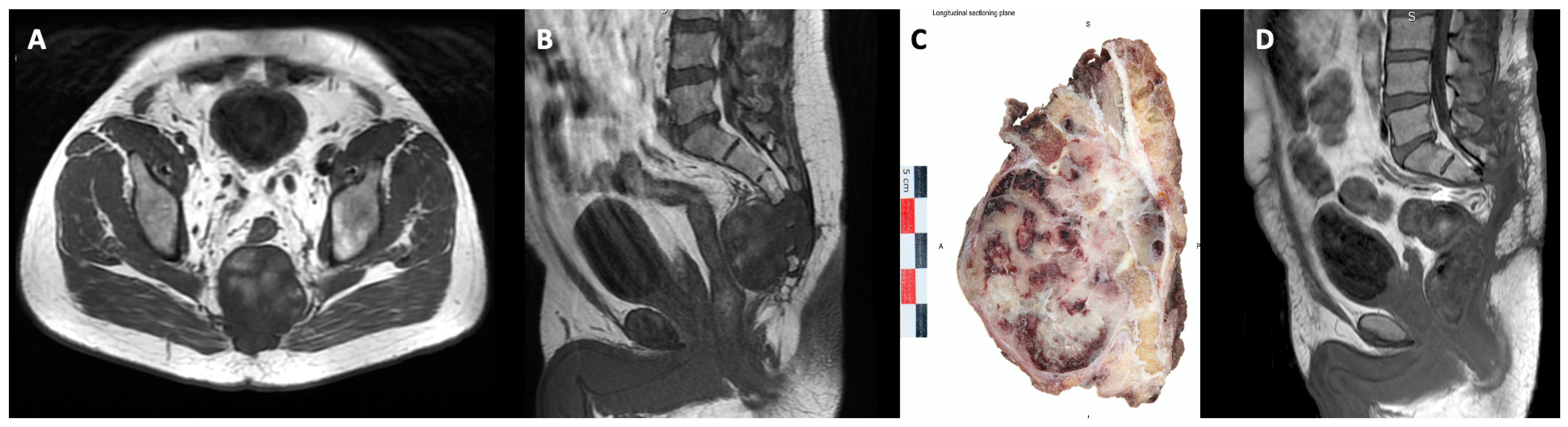 Cancers | Free Full-Text | Clinical Outcome after Surgical Treatment of ...