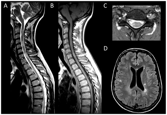 T2weighted Sagittal Mri Showing Spinal Cord Conus Spine