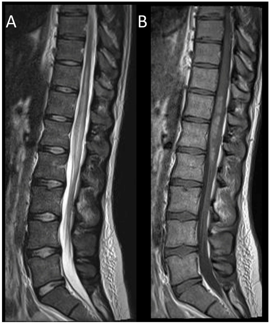 Cancers | Free Full-Text | It Looks Like a Spinal Cord Tumor but It Is Not