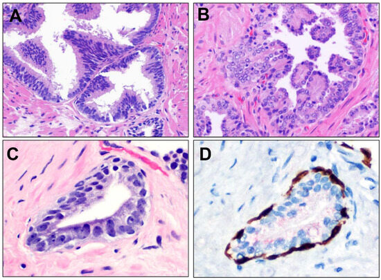 Intraductal Carcinoma of the Prostate versus Simulants: A Differential ...