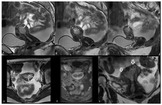 Performance of MRI for Detection of ≥pT1b Disease in Local Staging of ...