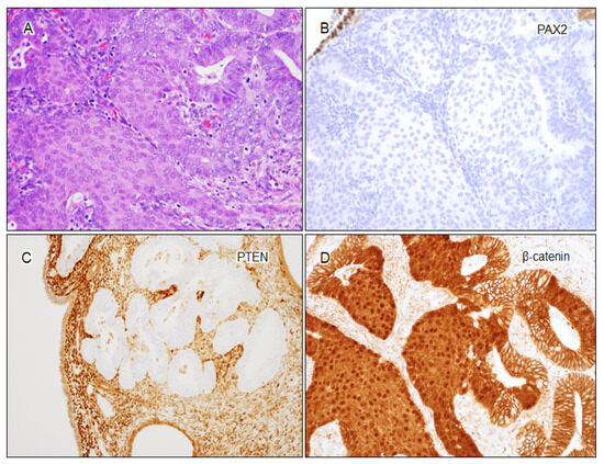 Biomarkers in the Diagnosis of Endometrial Precancers. Molecular ...