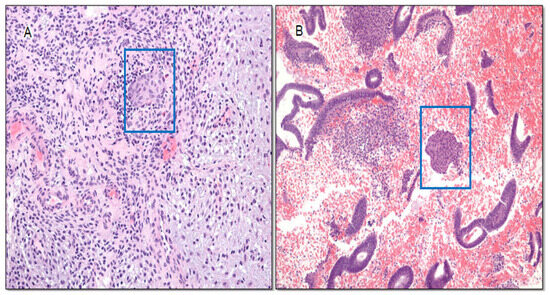 Cancers | Free Full-Text | Biomarkers in the Diagnosis of Endometrial ...