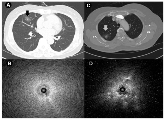 Endobronchial Ultrasound Using Guide Sheath-Guided Transbronchial Lung ...