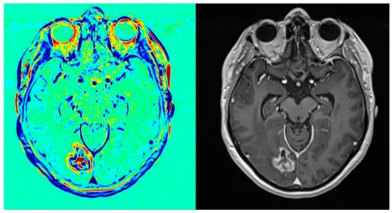 Contrast Clearance Analysis (CCA) to Assess Viable Tumour following Stereotactic Radiosurgery ...