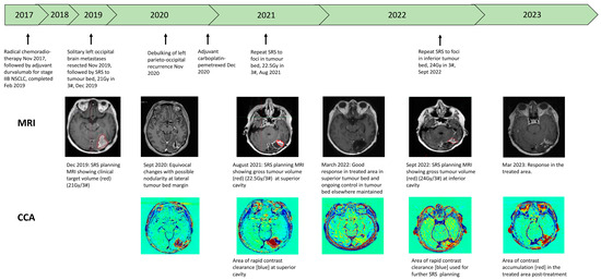 Contrast Clearance Analysis (CCA) to Assess Viable Tumour following Stereotactic Radiosurgery ...