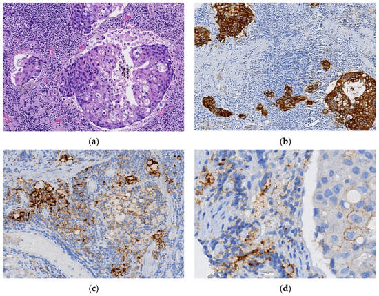 HER2 and PD-L1 Expression in Gastric and Gastroesophageal Junction Cancer: Insights for ...