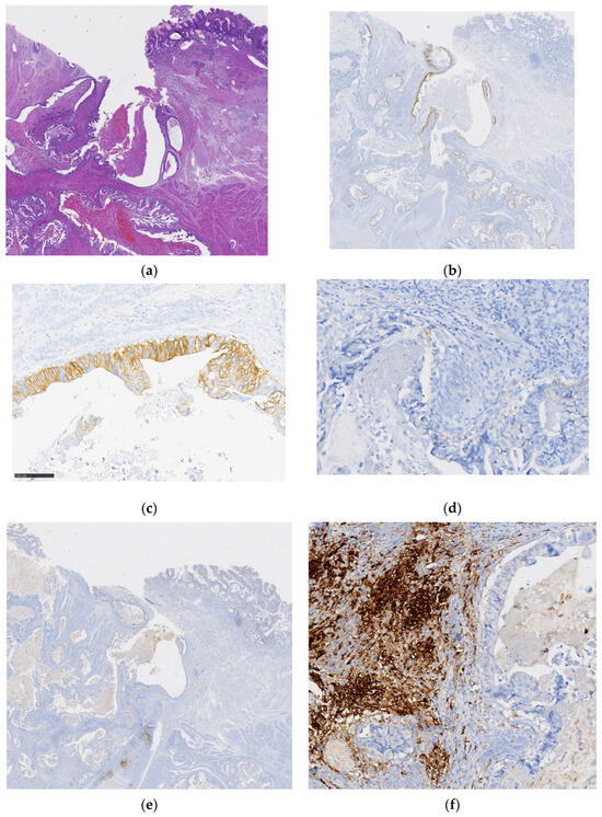 HER2 and PD-L1 Expression in Gastric and Gastroesophageal Junction Cancer: Insights for ...