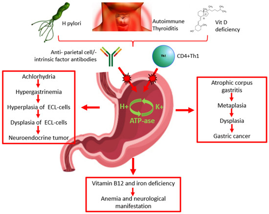 Cancers | Free Full-Text | Autoimmune Atrophic Gastritis: A Clinical Review