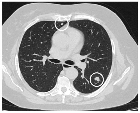 Colorectal Cancer Pulmonary Metastasectomy: When, Why and How