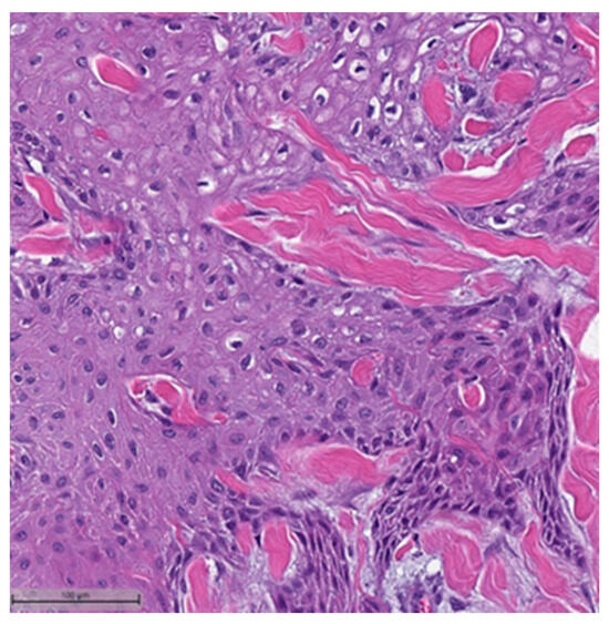 Translational Aspects in Metaplastic Breast Carcinoma