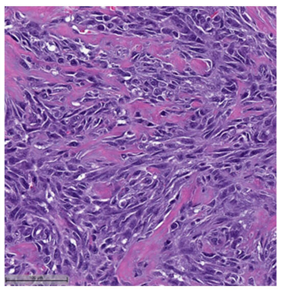 Translational Aspects in Metaplastic Breast Carcinoma