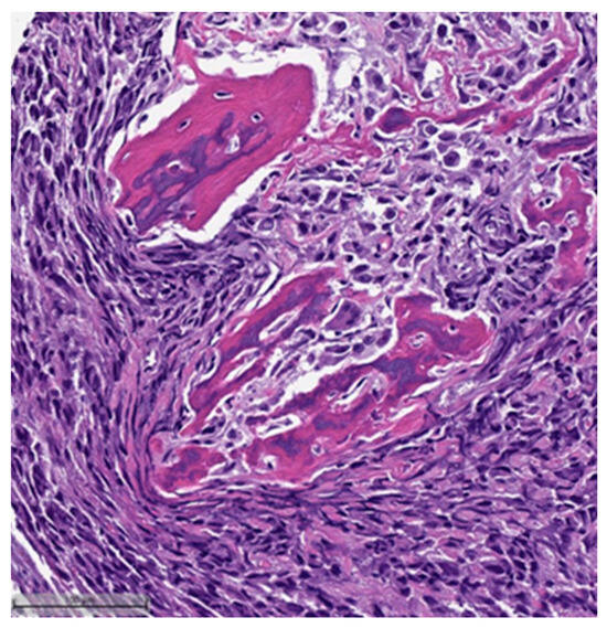 Translational Aspects in Metaplastic Breast Carcinoma