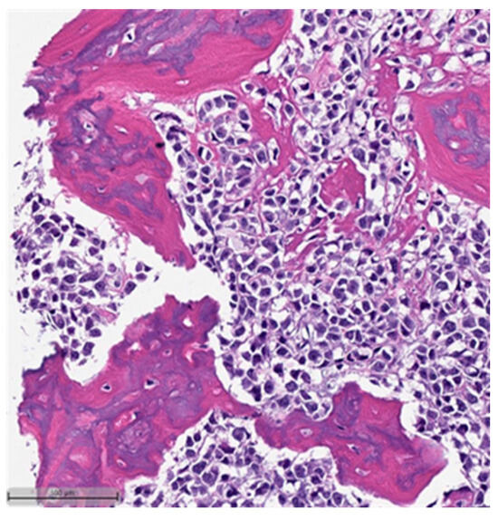 Translational Aspects in Metaplastic Breast Carcinoma