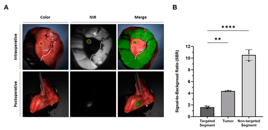 Simultaneous Visualization of Lung Tumor and Intersegmental Plane ...