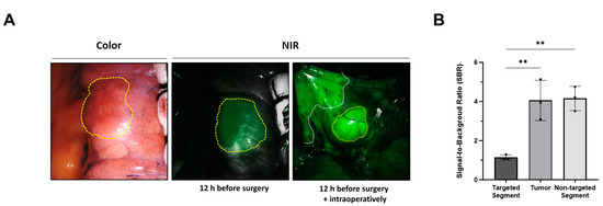 Simultaneous Visualization of Lung Tumor and Intersegmental Plane ...