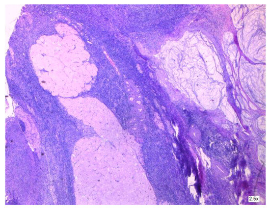 Ovarian Causes of Pseudomyxoma Peritonei (PMP)—A Literature Review