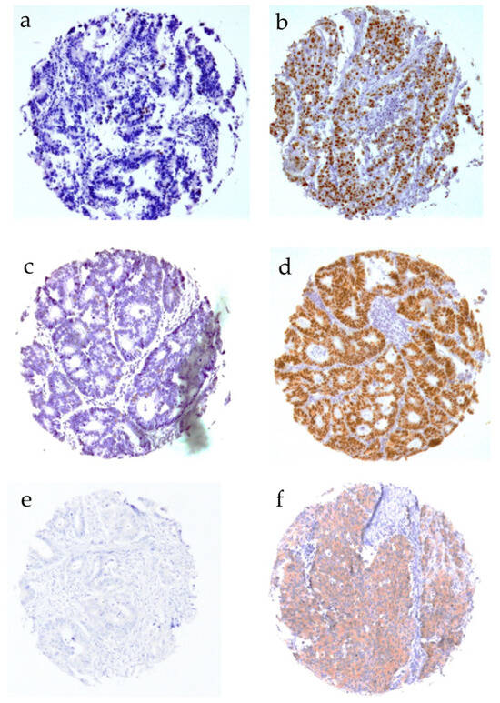 CD10 Expression Correlates with Earlier Tumour Stages and Left-Sided ...