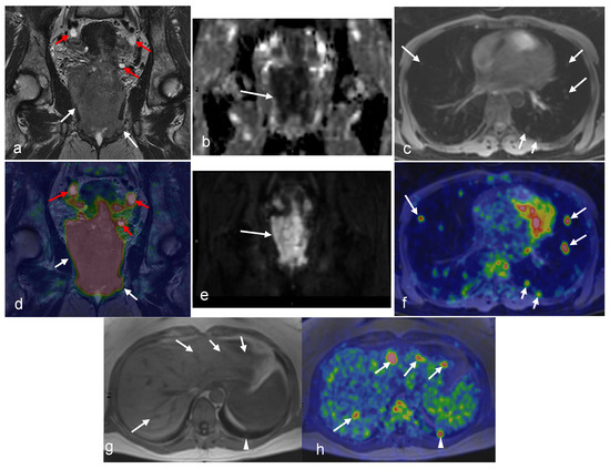 Application of PET/MRI in Gynecologic Malignancies
