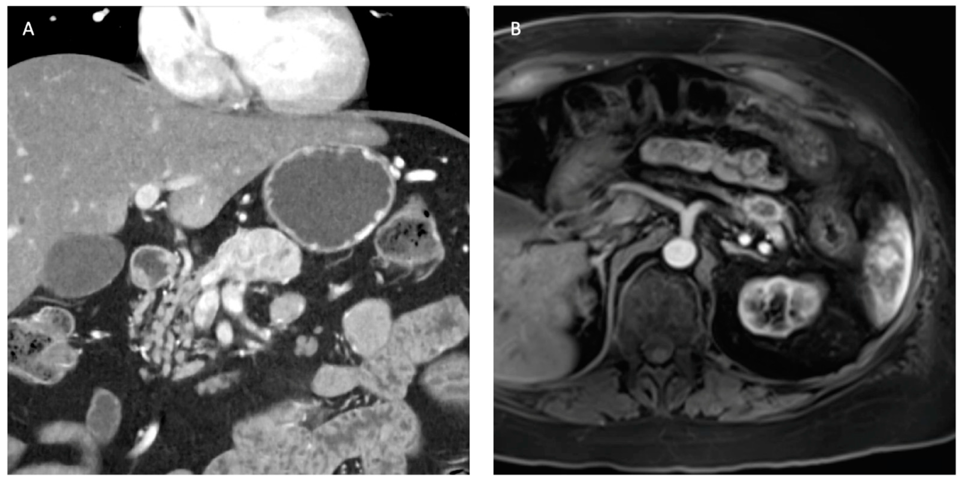 Contemporary Approaches to the Surgical Management of Pancreatic Neuroendocrine Tumors