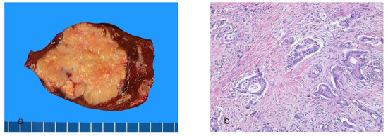 Recent Advances in Pathology of Intrahepatic Cholangiocarcinoma