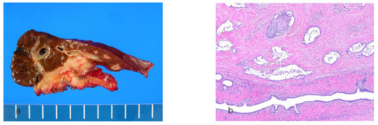 Recent Advances in Pathology of Intrahepatic Cholangiocarcinoma