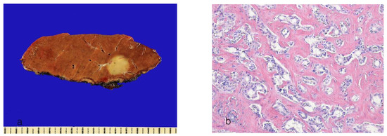 Recent Advances in Pathology of Intrahepatic Cholangiocarcinoma