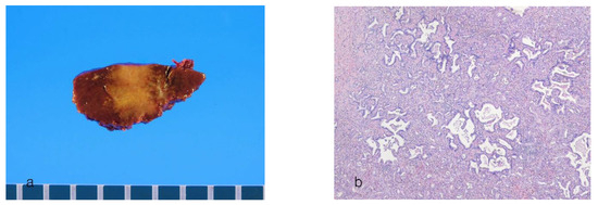Recent Advances in Pathology of Intrahepatic Cholangiocarcinoma