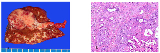Recent Advances in Pathology of Intrahepatic Cholangiocarcinoma