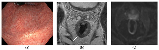 Surgical Outcomes after Radiotherapy in Rectal Cancer