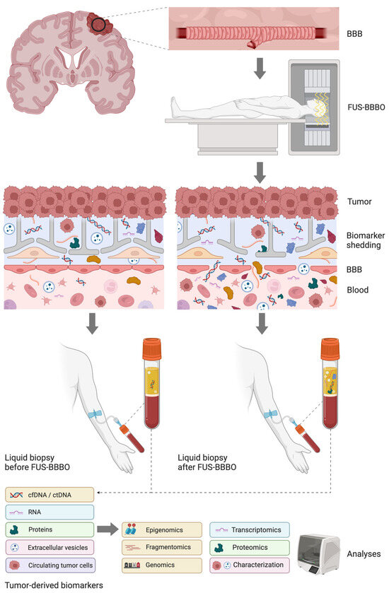 Focused Ultrasound-Enhanced Liquid Biopsy: A Promising Diagnostic Tool for Brain Tumor Patients