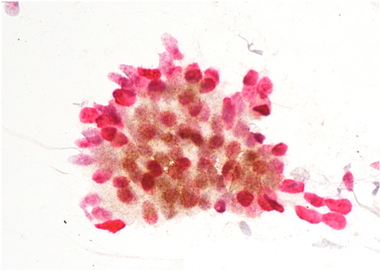 P16/Ki67 Dual Staining in Glandular Cell Abnormalities of the Uterine ...